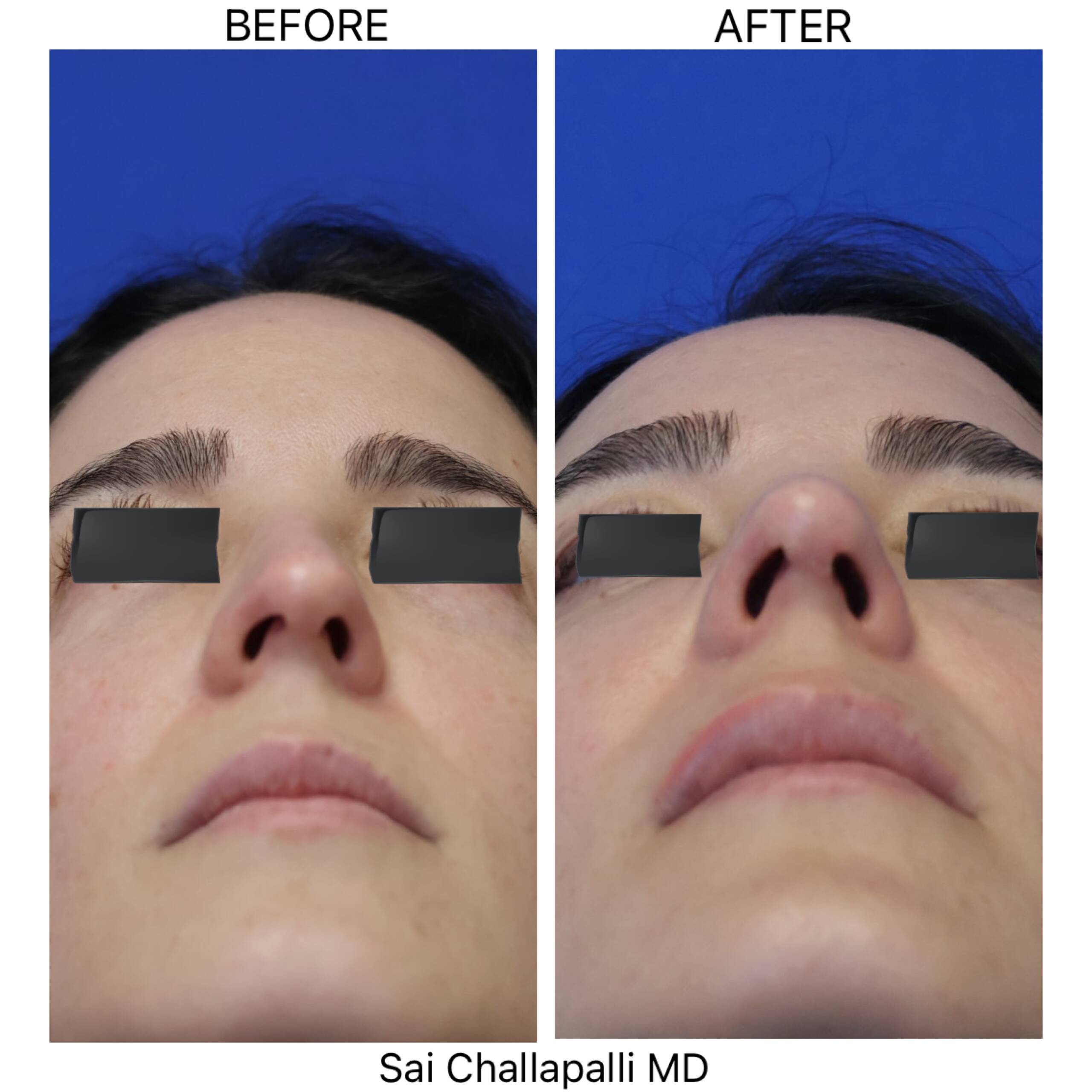 RHINOPLASTY – Dr Challapalli